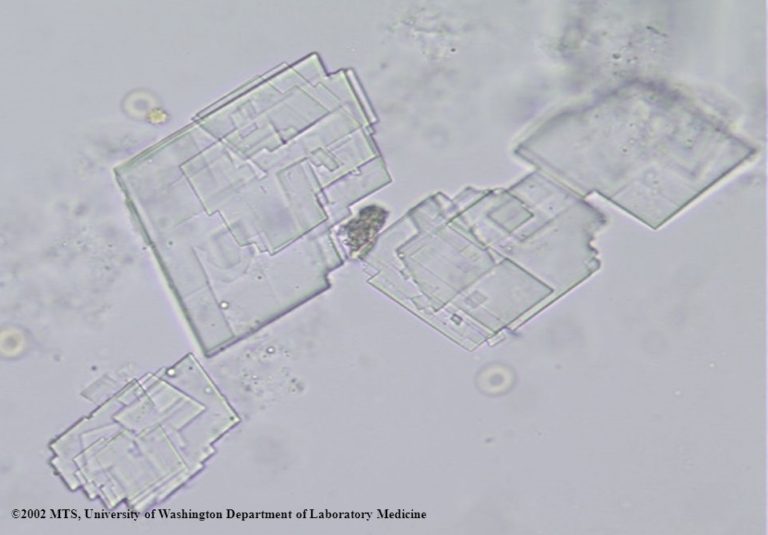 What are the types of Crystals found in Urine?