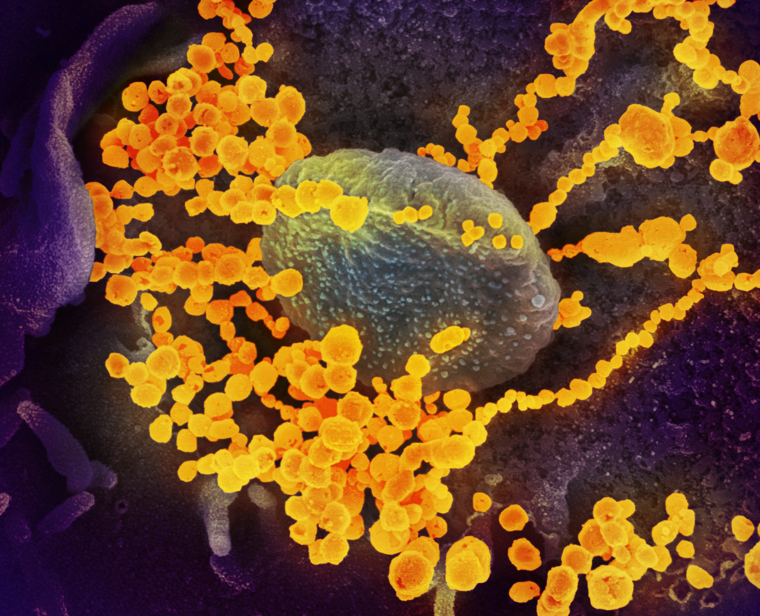 Electron microscopy (SEM and TEM) images of SARS-CoV-2
