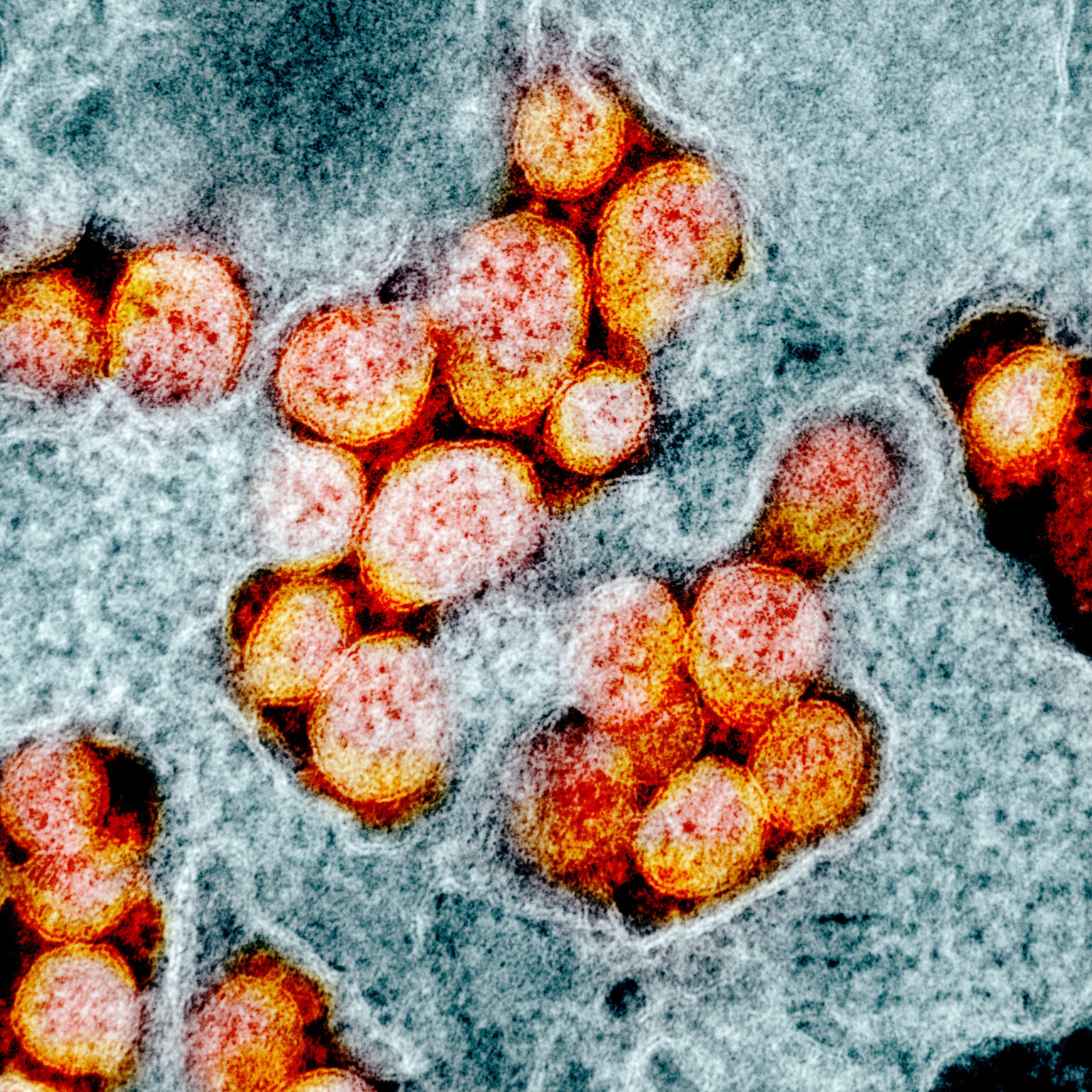 Electron microscopy (SEM and TEM) images of SARS-CoV-2