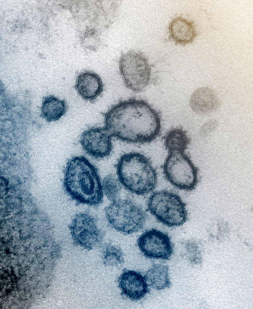 Electron microscopy (SEM and TEM) images of SARS-CoV-2