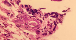 Sporothrix schenckii- An Overview