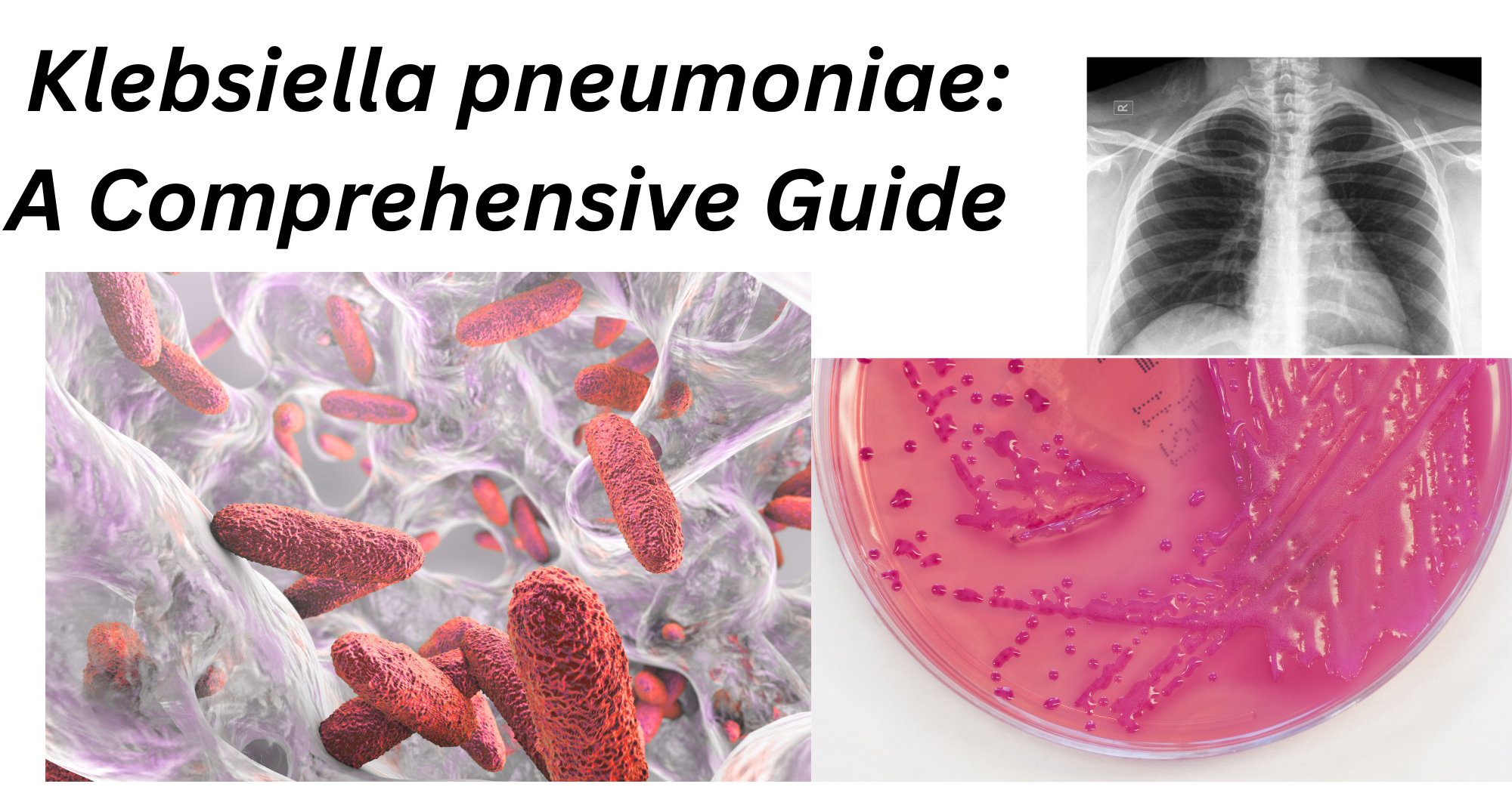 Klebsiella pneumoniae: A Comprehensive Guide