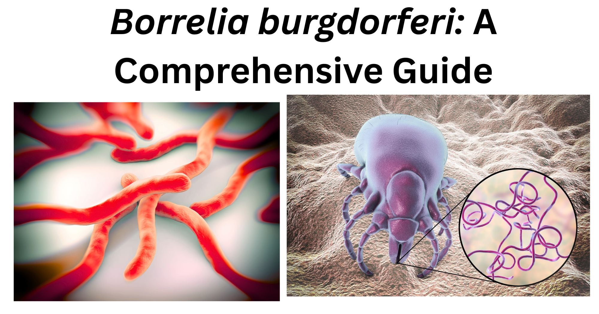 Borrelia burgdorferi (Lyme Disease): An Overview