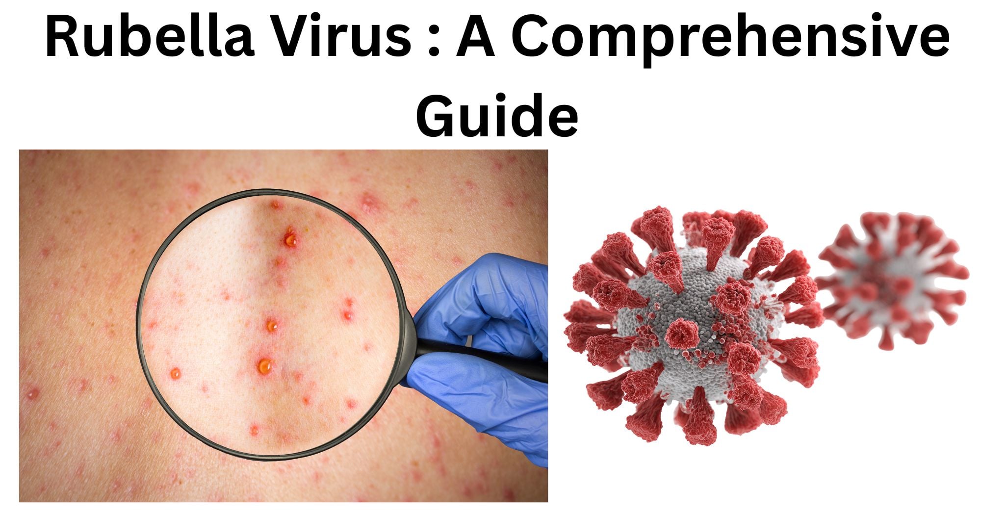 Rubella Virus: A Comprehensive Guide